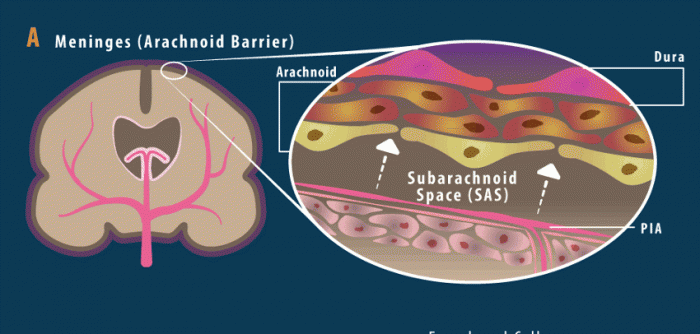 Arachnoid Cyst Symptoms Hrf
