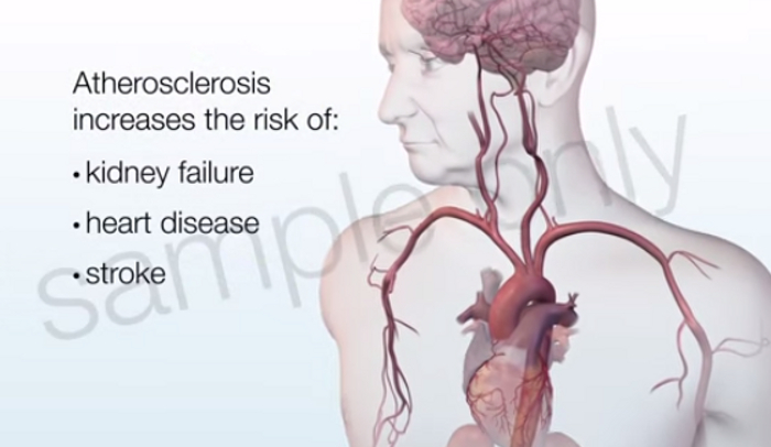 10 Important Facts About Atherosclerosis - HRF